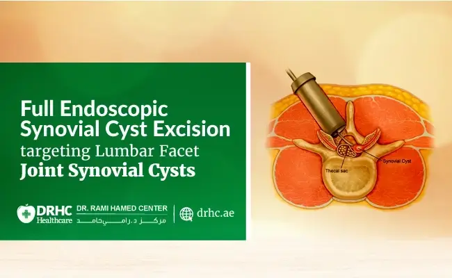 Full Endoscopic Synovial Cyst Excision Targeting Lumbar Facet Joint Synovial Cysts